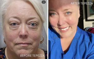 What is Tepezza? | Tepezza TED - Thyroid Eyes Treatment